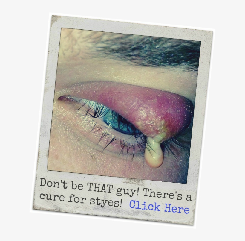 Eye Stye - Free Transparent PNG Download - PNGkey