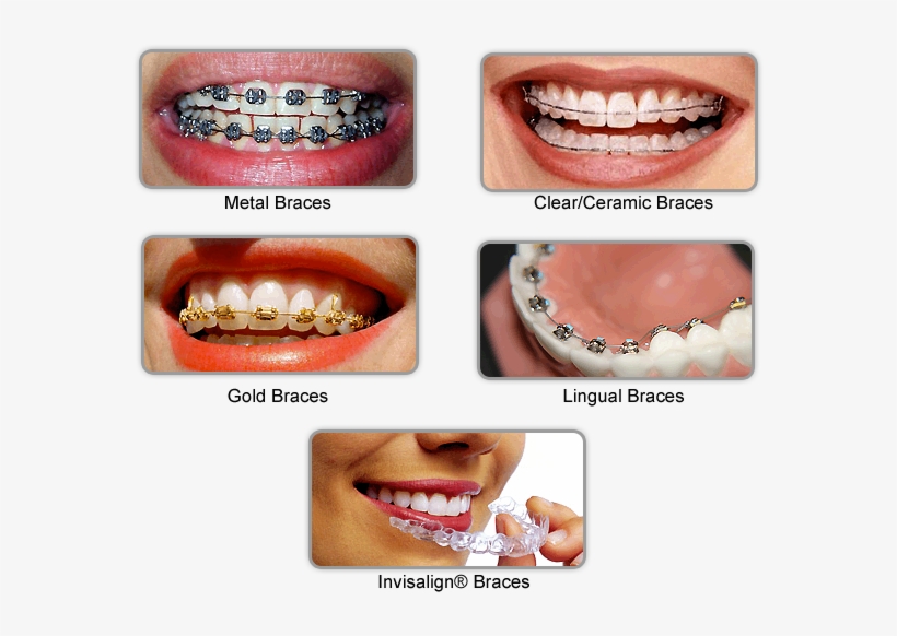 Clear Aligners - Free Transparent PNG Download - PNGkey