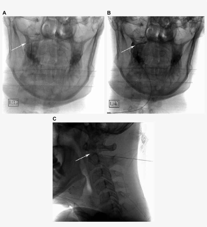 Needle Position And Contrast Filling Of The C1 2 Joint - Cervical 0 C1 ...