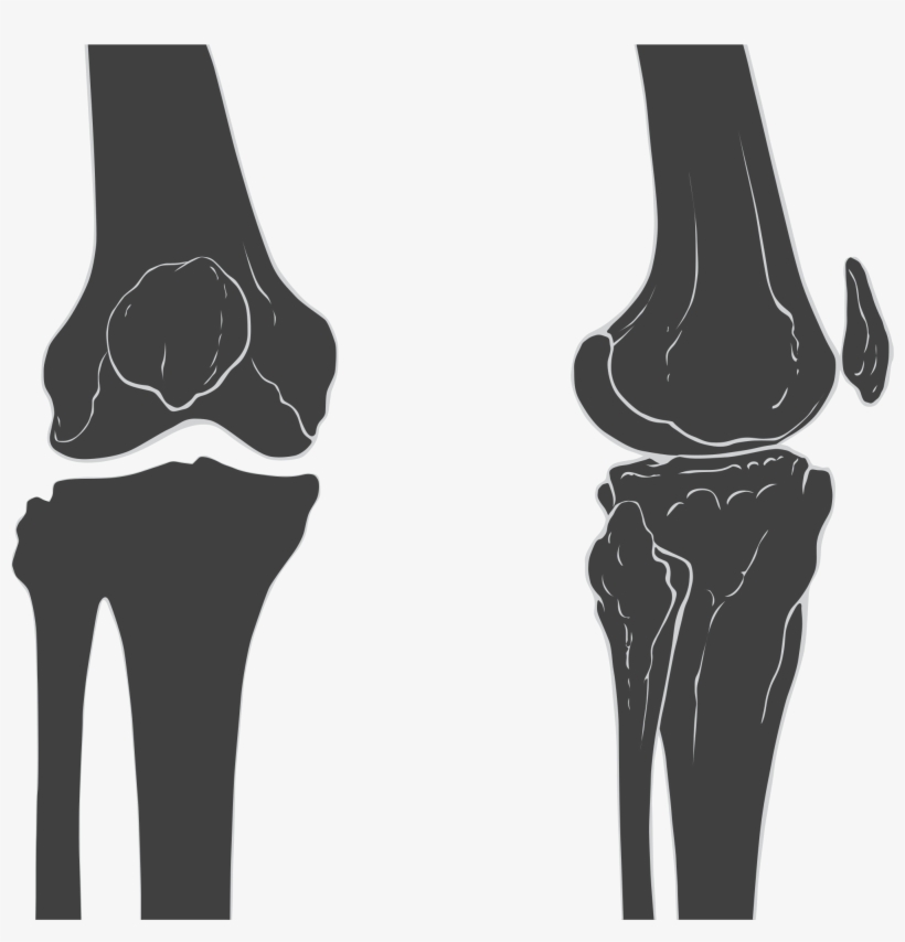 Open - Knee Skeleton - Free Transparent PNG Download - PNGkey