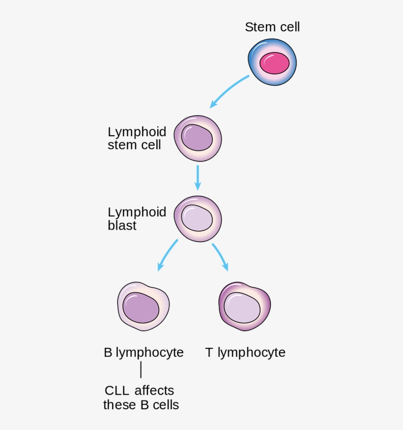 Picture - Acute Lymphoblastic Leukemia Formation - Free Transparent PNG ...