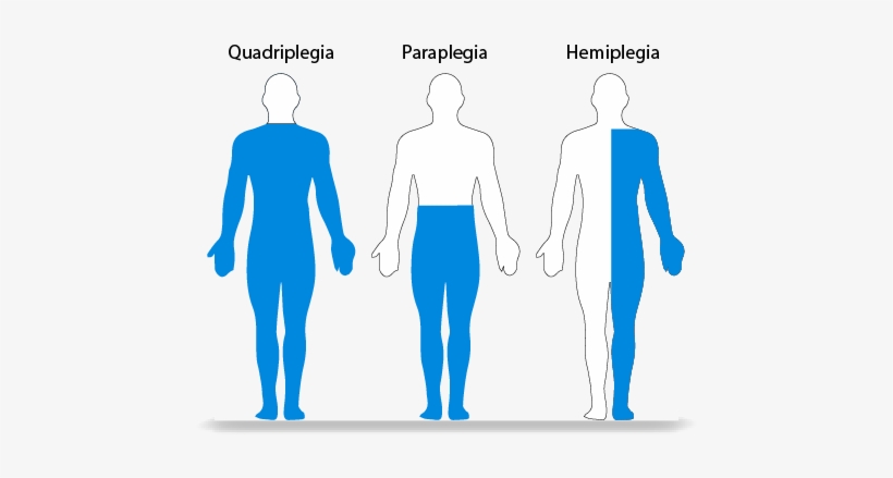 Conventional Method To Treat A Spinal Cord Injury - Paraplegia ...