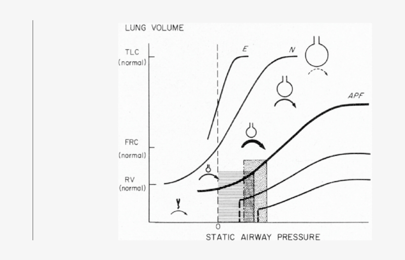 Use Of The Pressure/volume Curve To Personalize Peep - Cartoon - Free ...