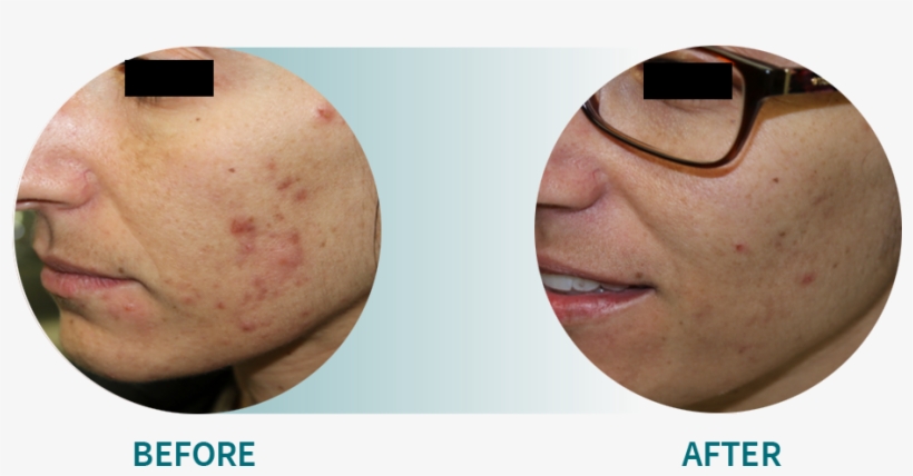 Active Acne/acne Scars - Stretch Marks Before And After - Free ...