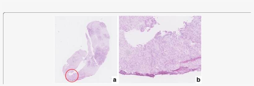 Pathological Analysis By Open Surgical Biopsy In Case - Drawing - Free ...