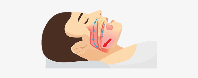 What Is Obstructive Sleep Apnea - Sleep Apnea Png - Free Transparent ...