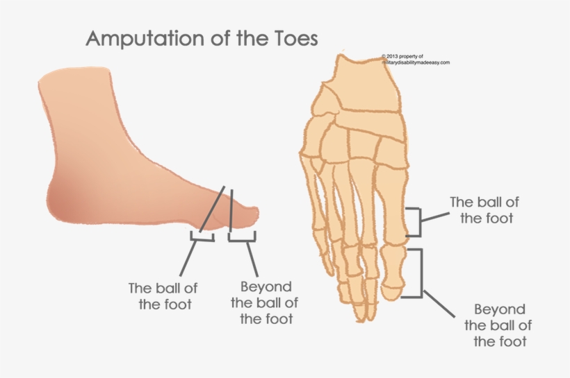 The Foot 11 - Partial Toe Amputation - Free Transparent PNG Download ...