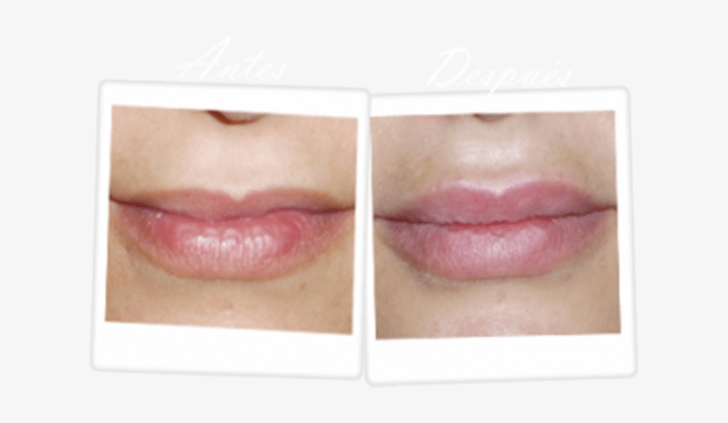 Aumento De Labios Cirugia - Surgery - Free Transparent PNG Download ...