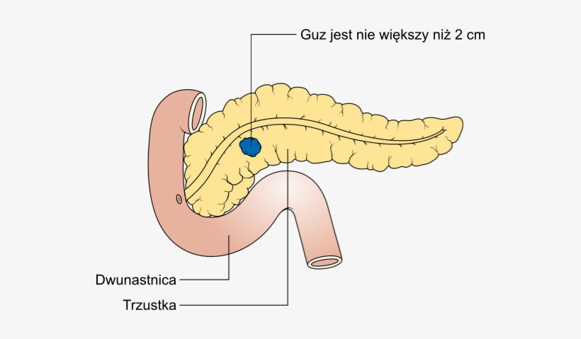 Diagram Showing Stage T1 Cancer Of The Pancreas Cruk - Rak W 4 Stadium ...