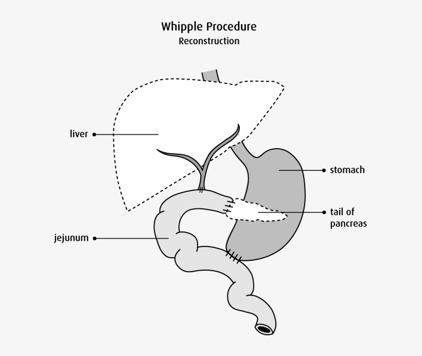 Diagram Of Reconstruction In A Whipple Procedure ...