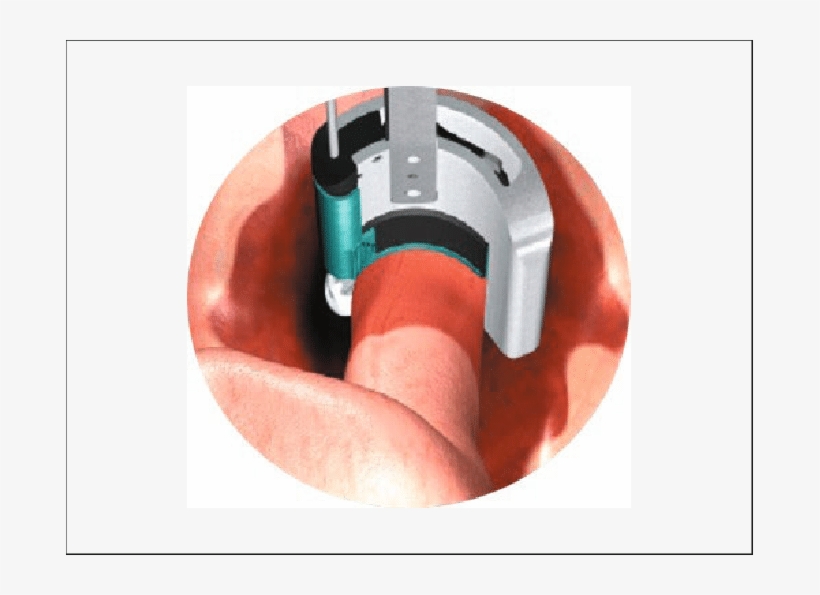 Schematic Show Of The Curvilinear Cut Of The Colon - Large Intestine ...