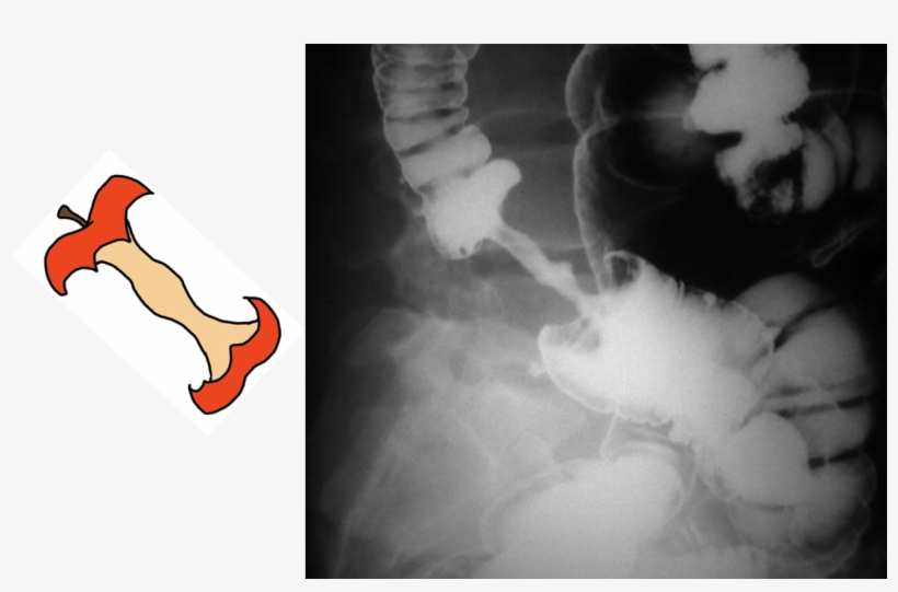 Colorectal Cancer Barium Enema - Free Transparent PNG Download - PNGkey