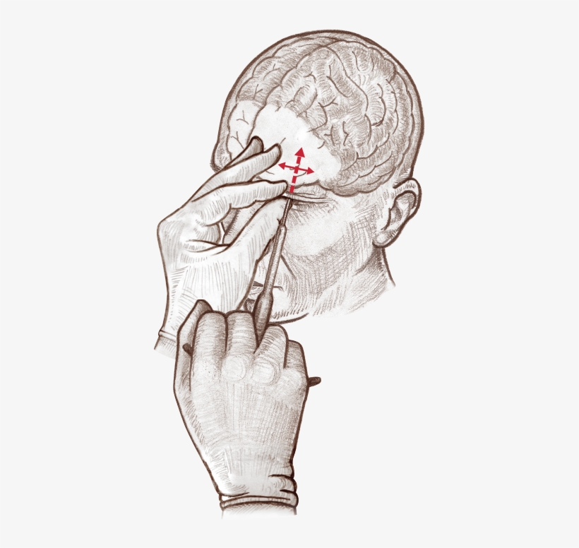 Transorbital Lobotomy A Doctor Inserted A Tool Similar - Trans Orbital ...