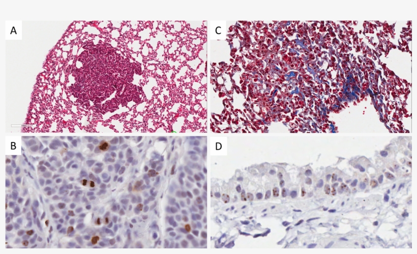Lung Cancer Cell Proliferation Measured By Phospho - Normal Lung Tissue ...