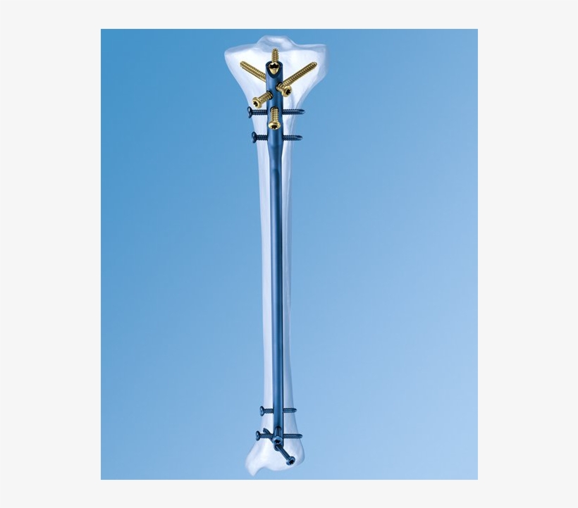 Titanium Cannulated Tibial Nail Ex - Synthes Tibial Nail - Free ...