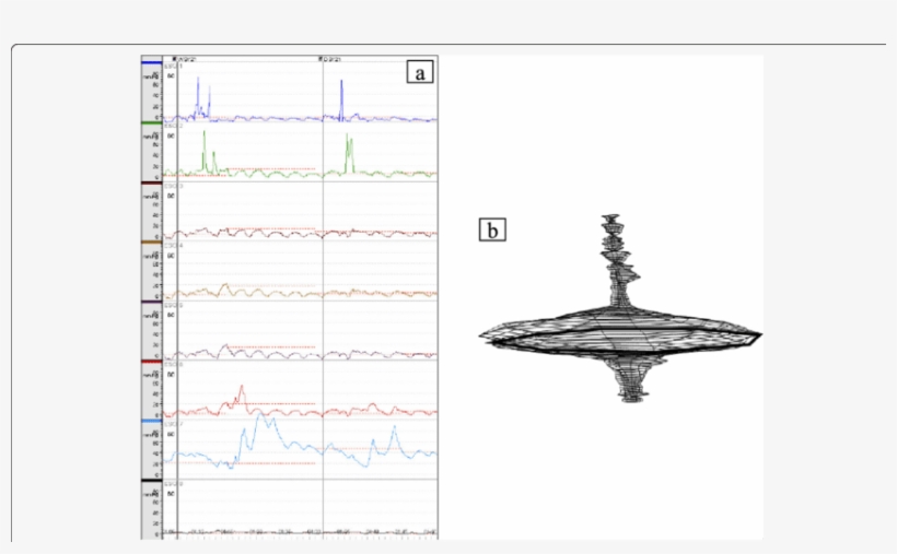 Preoperative Esophageal Manometry Findings - Sketch - Free Transparent ...