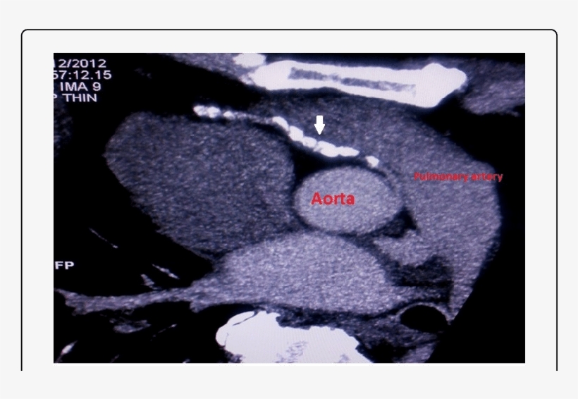 Gd-enhanced Ct Angio With Mip Image Showing Anomalous - Free ...