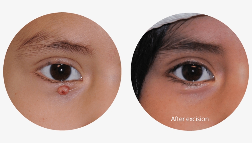 Pyogenic Granuloma Of A Lower Eyelid Before And After - Eyelid - Free ...