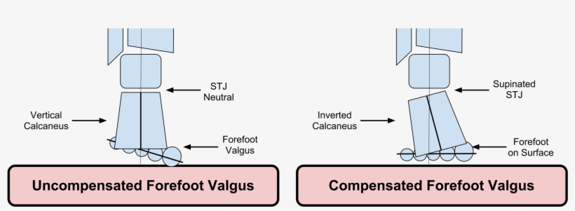 Forefoot Varus And Valgus - Free Transparent PNG Download - PNGkey