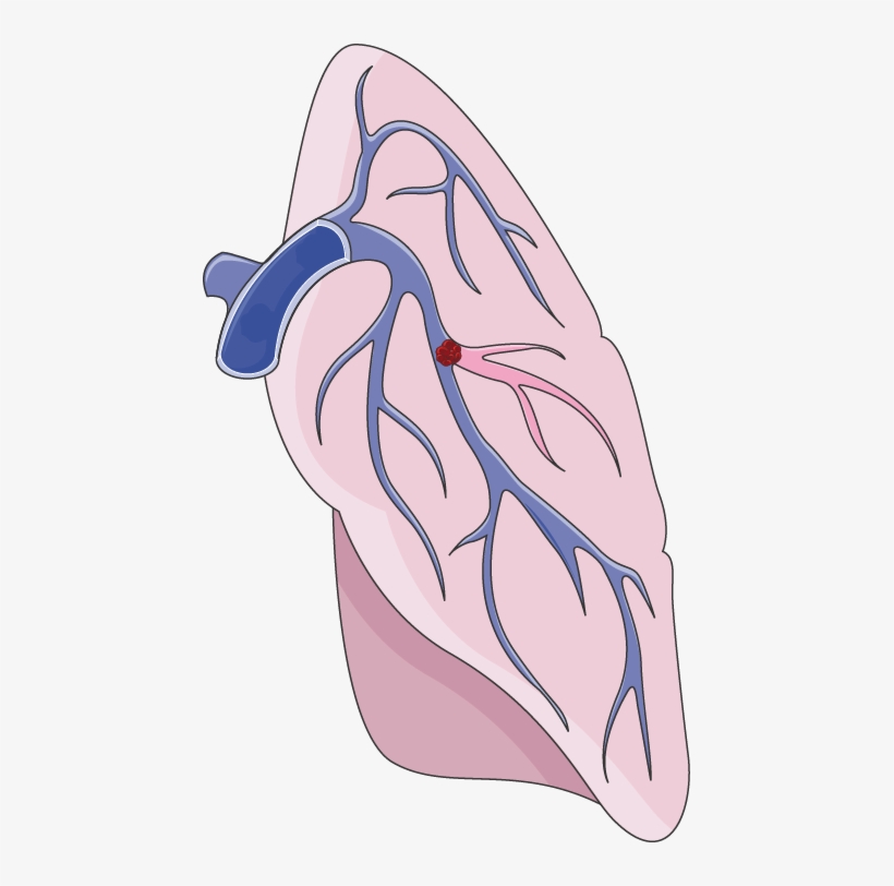 Pulmonary Embolism - Free Transparent PNG Download - PNGkey