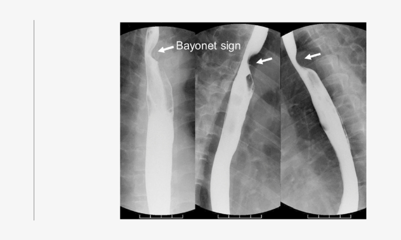 Upper Gastrointestinal Series Showed The Bayonet Sign, - Free ...