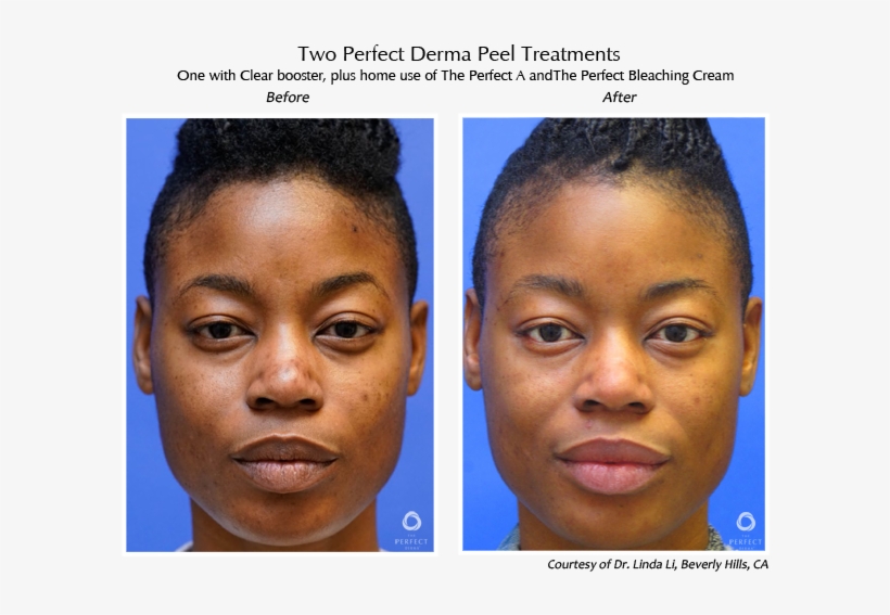 Before & After - Free Transparent PNG Download - PNGkey