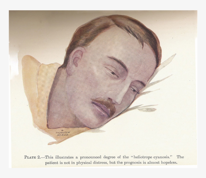 This Drawing Of A Man With Cyanosis Shows The Purple-blue - Visual Arts ...