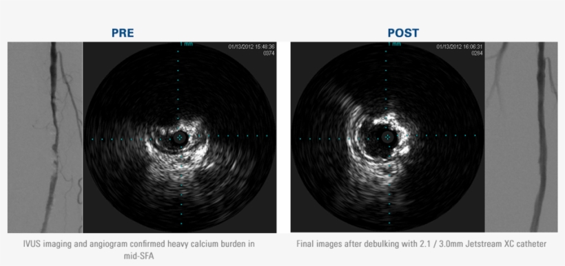 Noticeable Calcium Reduction In Right Sfa After Treatment - Calcium On ...