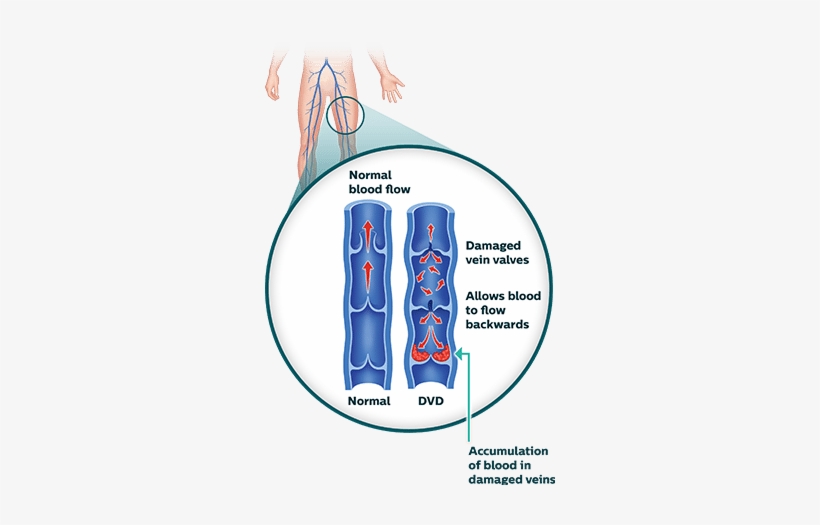 Deep Venous Disease - Dvo Deep Venous Obstruction - Free Transparent ...