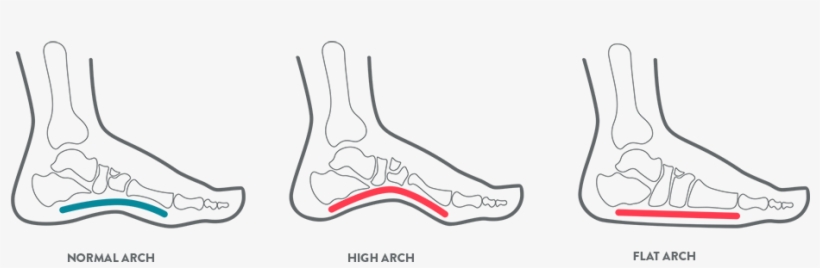 A Kids Foot Health Diagram Illustrating Arch Position - Foot Bones Kid ...