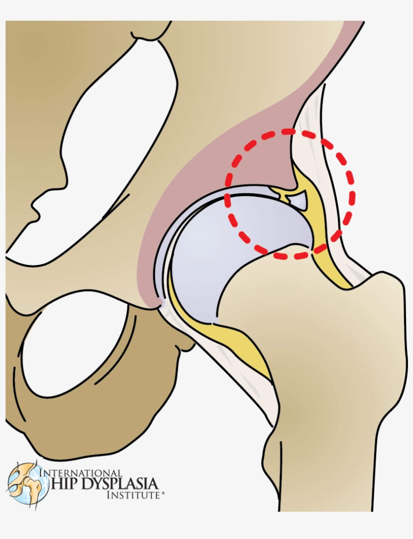 Torn Labrum Illustration [ ] Enlarge - Drawing Of Torn Labrum Hip ...