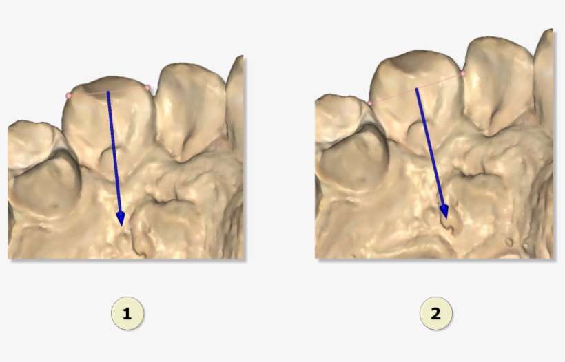 File - Maestro3d - Dental - Studio - Mesio - Distal3 - Diagram - Free ...