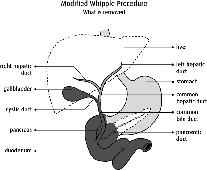 Diagram Of What Is Removed In A Modified Whipple Procedure - Modified ...
