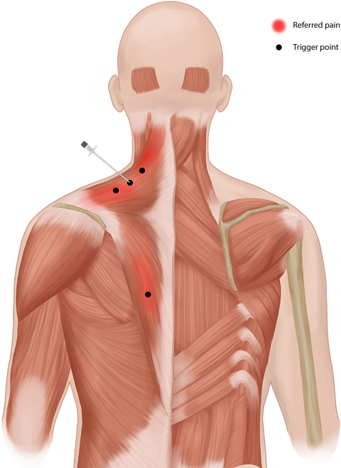 Download Trigger-pain - Trigger Points Injections PNG Image with No ...