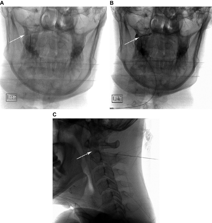 Download Needle Position And Contrast Filling Of The C1 2 Joint ...