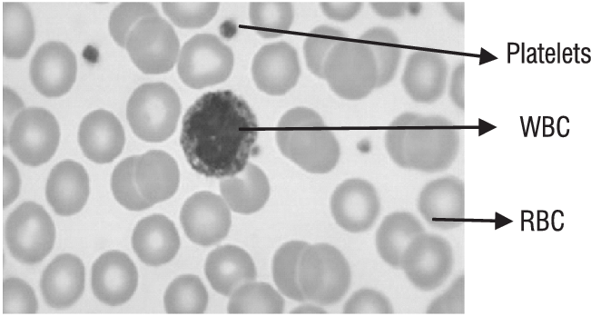 Download A Sample Blood Smear Showing Rbc, Wbc, Platelets Table - Pernicious Anemia Vs Normal ...