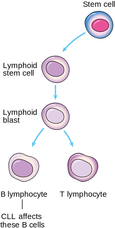Picture - Acute Lymphoblastic Leukemia Formation - Free Transparent PNG ...