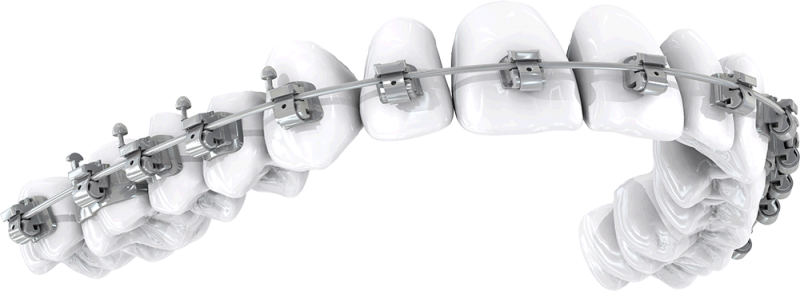 Download Why Braces - Orthodontic Brackets Png PNG Image with No ...
