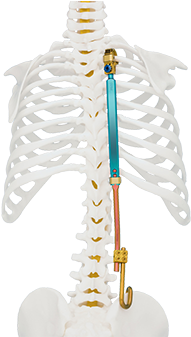 Download Veptr Ii Vertical Expandable Prosthetic Titanium Rib ...