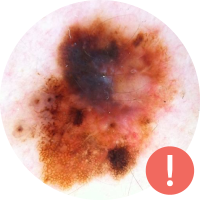 Download Cancerous Mole - Multi Colour Mole PNG Image with No ...