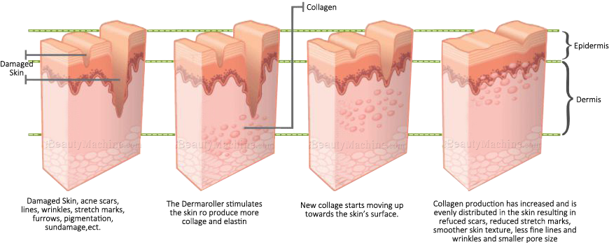 Download Derma Needling System Titanium Micro Needle Roller - Fine ...