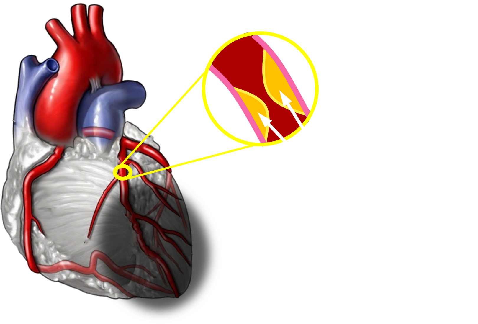A Severe Heart Attack Can Cause Permanent Damage To - Rheumatoid ...