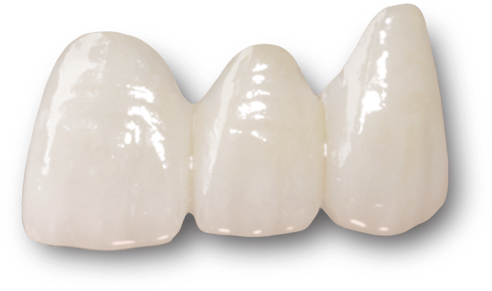 Ceramic Dental Bridges - Emax Crown - Free Transparent PNG Download ...