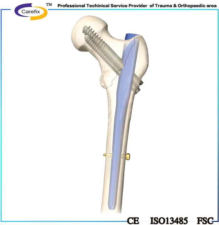 Download Carefix Femur And Tibia Interlocking Nail,metallic - Orthopaedic Femoral Surgery PNG ...
