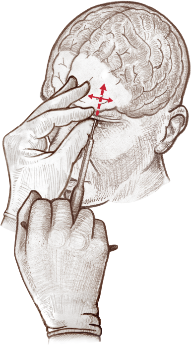 Download Transorbital Lobotomy A Doctor Inserted A Tool Similar - Trans ...