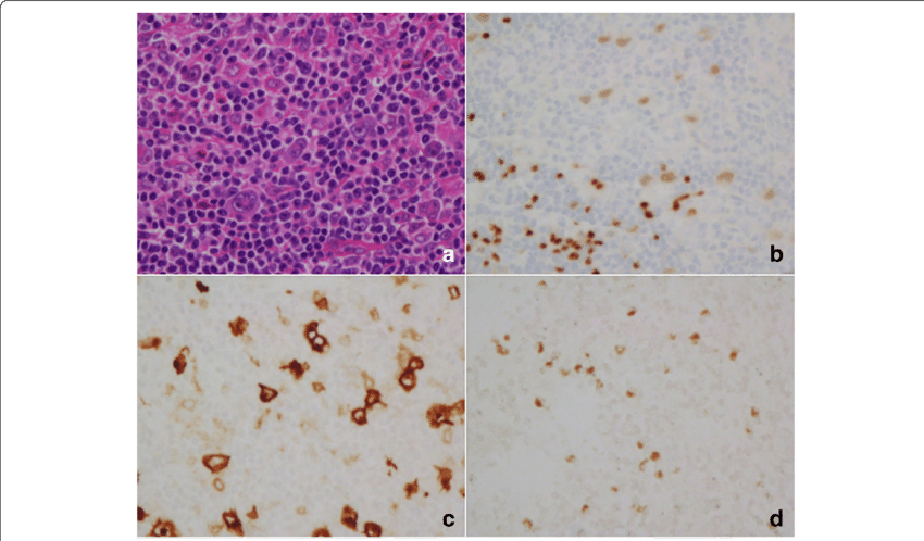 Download A Mononuclear Hodgkin Cells And Mutinucleated Reed-sternberg ...