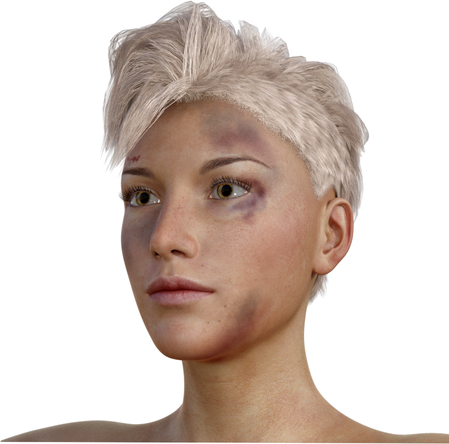 My Heart Raced And I Wanted To Intervene - Bruise - Free Transparent ...