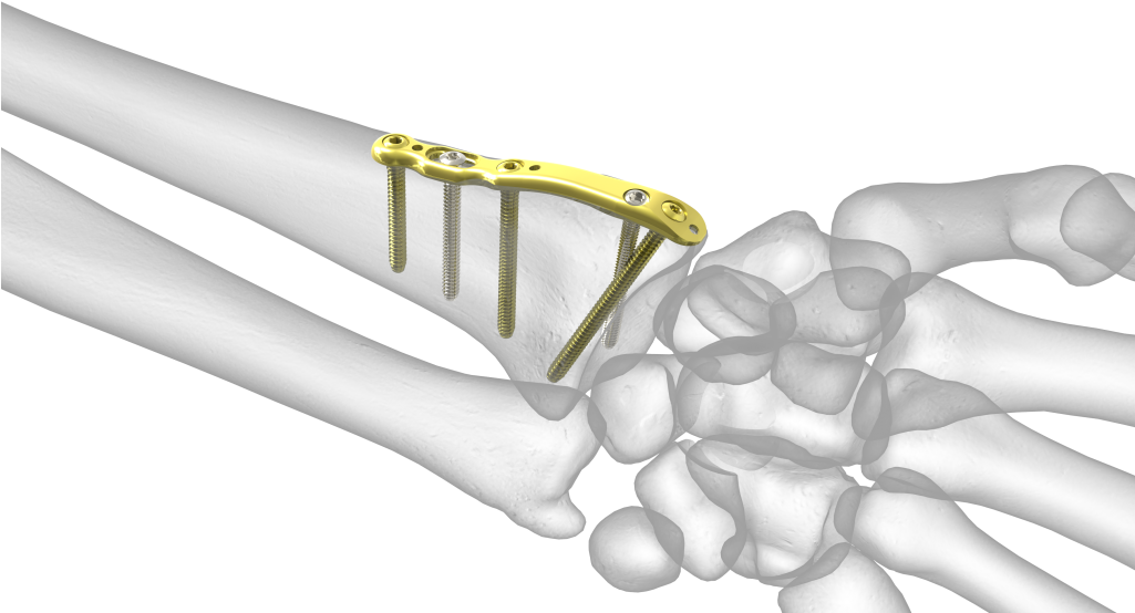 Download Divergent Radial Styloid Plate - Radial Styloid Plate PNG ...