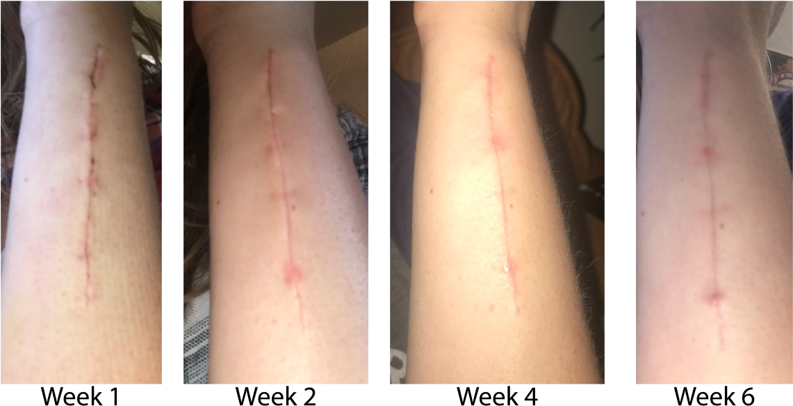 Mary's Cbc Compound Scar Progression - Scar Progression - Free ...