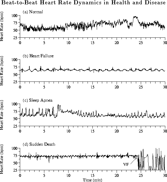 Download Heart Rate Time Series Of 30 Min From (a) A Healthy - Heart ...